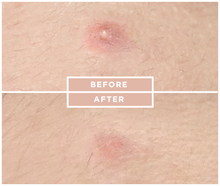 8 Things I Love About This Acne Patch Set ! - Biotyful.net